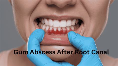Gum Abscess After Root Canal Cypress Towne Dental