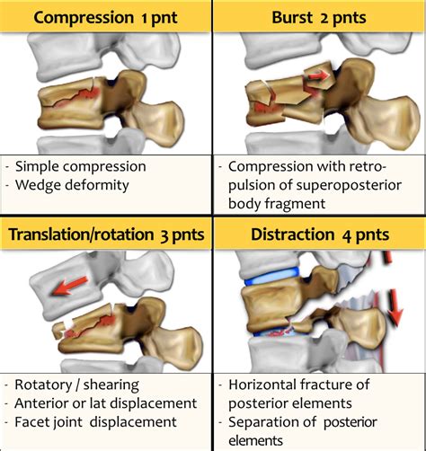 Types Of Spinal Fractures Radiology At Roberta Shanklin Blog