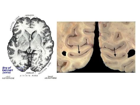 Cerebral Cortex Dr Altdorfer Neocortex Isocortex F Mri
