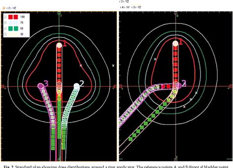 Figure 2 From Tandem Ring Dwell Time Ratio In Nigeria Dose Comparisons