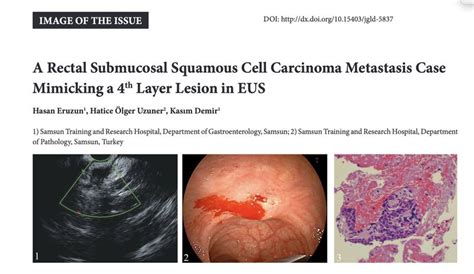 Hasan Eruzun On Linkedin A Rectal Submucosal Squamous Cell Carcinoma
