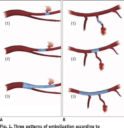 Figure 1 From Recent Update Of Embolization Of Upper Gastrointestinal