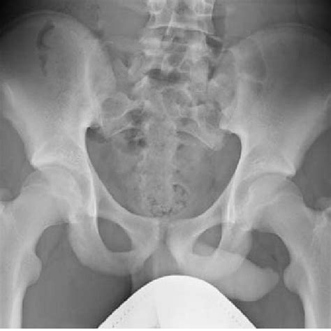 Initial Pelvic X Ray With Bilateral Sacroiliac Dislocation Without Download Scientific Diagram