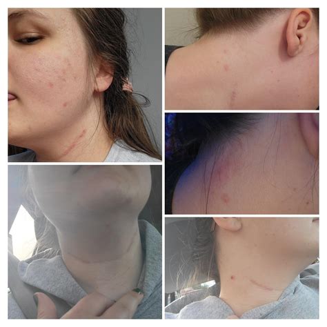 One Year Ago I Had A Bilateral Styloidectomy To Remove 6 Cm Calcified Styloid Ligaments As Well