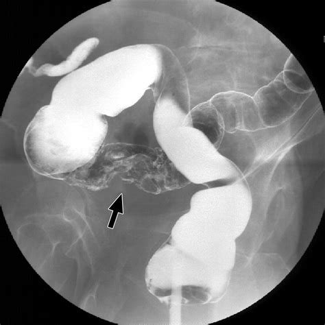 Angiodysplasia Mimicking Colon Cancer Colonoscopy Double Contrast