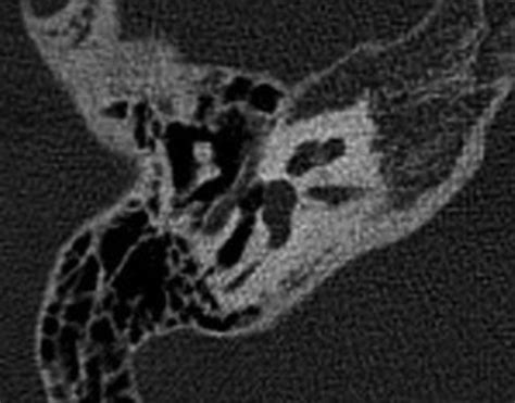 Cochlear Aperture Stenosis Accompanying Microcochlea On The Right The Download Scientific