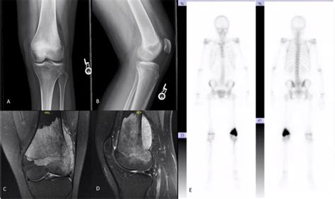 The Management Of An Open Biopsy Tract Site Infection And Ulceration In