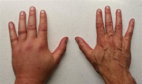 Hand Swelling Bite
