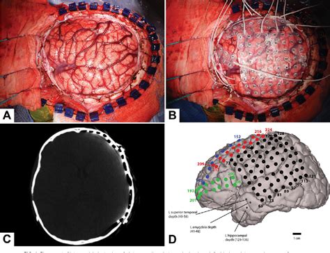Figure 1 From Intracranial Eeg For Seizure Focus Localization Evolving Techniques Outcomes