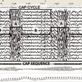Baseline EEG Tracing During NREM Sleep Download Scientific Diagram