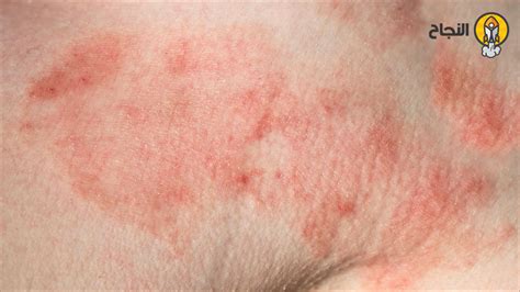 التهاب الجلد الدهني والتهاب الجلد التأتبي تعرف إلى أهم الفروقات