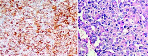 Microscopic Findings Of The Oncocytic Variant Adrenocortical Tumor Download Scientific Diagram