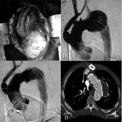 A The Intraoperative View Of The Ascending Aorta After Debranching The Download Scientific