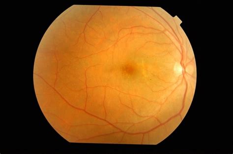 Exudative CSCR Retina Image Bank