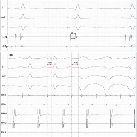 A Ecg On The Day Of The Episode Showing Complete Lbbb B Subsequent