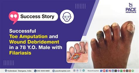 Filariasis Treated With Toe Amputation And Wound Debridement