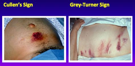 Acute Pancreatitis Grey Turner Sign