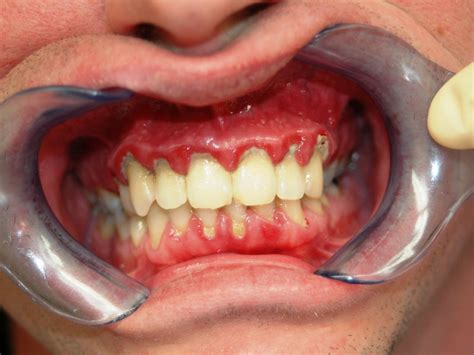 Gingivitis Doccheck