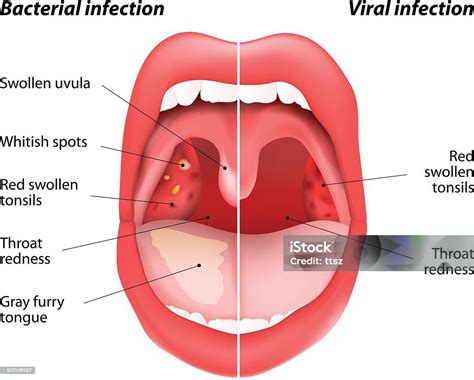 The Differences Between Viral And Bacterial Infections Stock