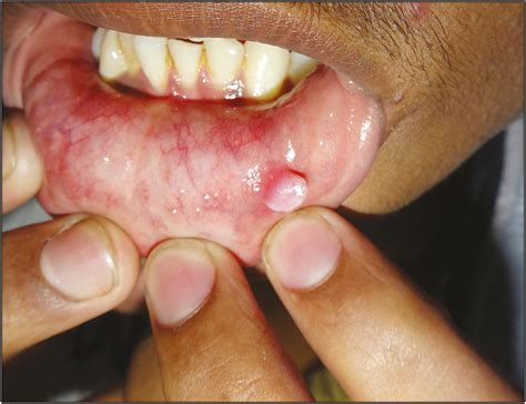 Surgical Management Of Oral Mucocele Experience With Marsupialization Jcas