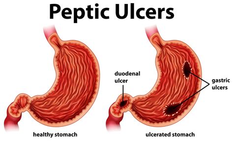 Diagram Showing Peptic Ulcers 299443 Vector Art At Vecteezy