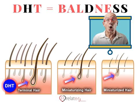 How Does DHT Responsible For Baldness Androgenic Alopecia Part 1