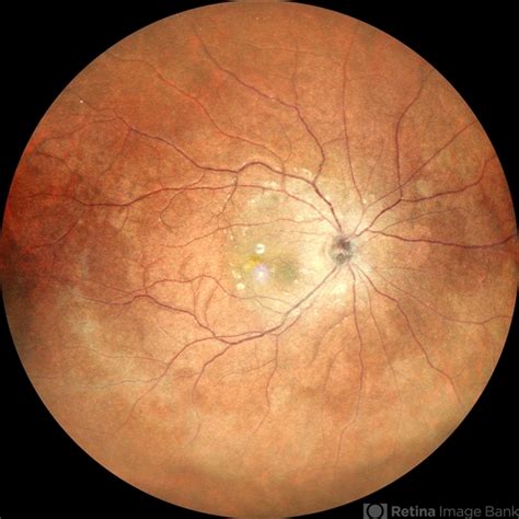 Syphilitic Posterior Uveitis Retina Image Bank