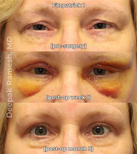 Eyelid Surgery