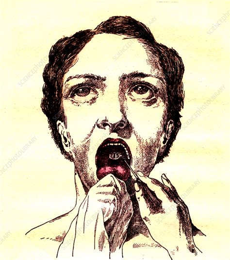 Laryngitis Examination 19th Century Illustration Stock Image C061