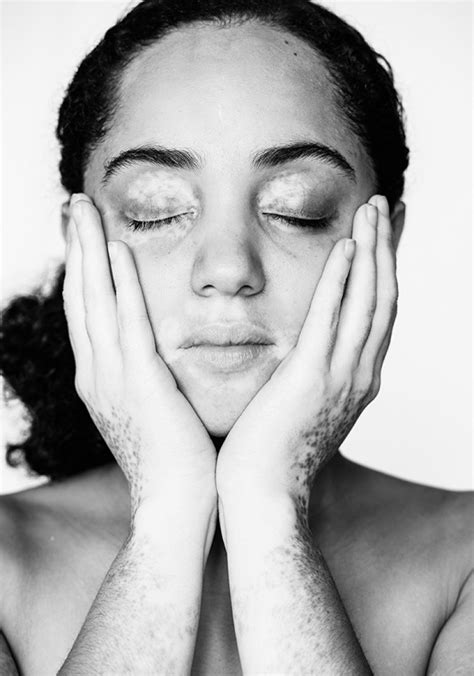 Discover The Beauty Of Vitiligo Pictolic