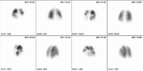 Lung Perfusion Scan In Cteph Showing Homogeneous Ventilation And Download Scientific Diagram