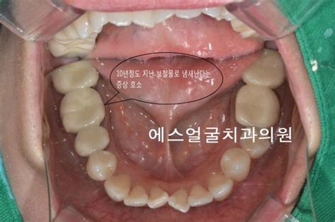 에스얼굴치과의원 오래된 보철물 제거후 신경치료 네이버 블로그