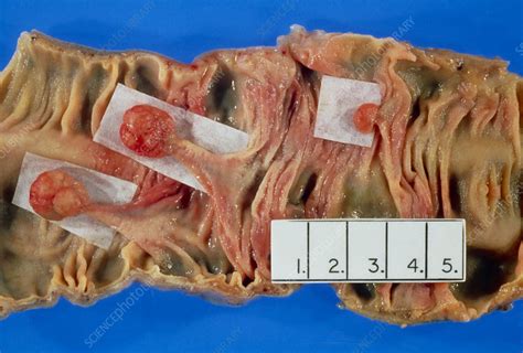 Hyperplastic Polyp Gross