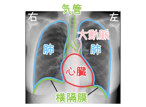 胸部レントゲンの見方心臓編 見てわかる病態生理と看護花子のまとめノート