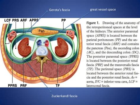 Retroperitoneal Masses Radiology