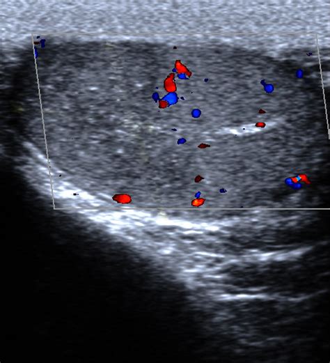 Segmental Testicular Infarction Pacs