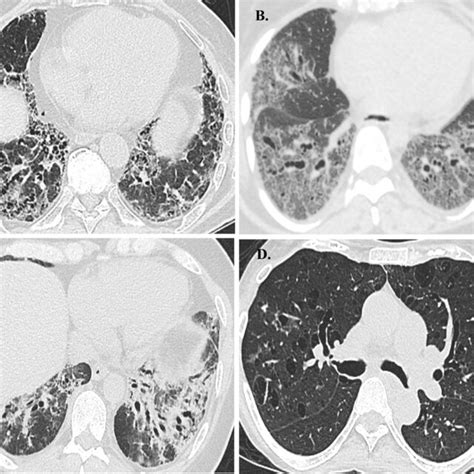Patterns Of Interstitial Lung Disease On High Resolution Computerized Download Scientific