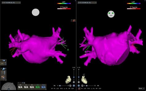 left atrial ct scan segmentation cardiac computed tomography with a