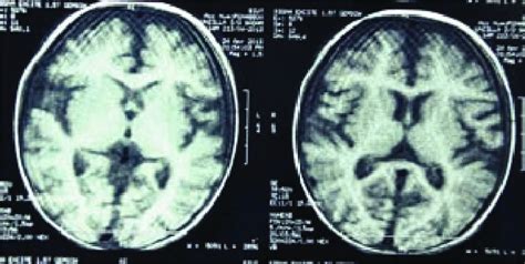 Magnetic Resonance Imaging Mri Of The Brain Showing Generalized