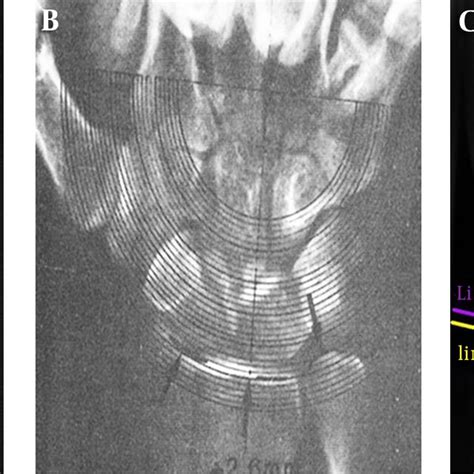 The Most Common Methods Of Ulnar Variance Assessment Download Scientific Diagram