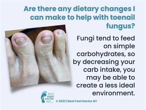 Toenail Fungus What Is It How To Prevent And Treat It Nyc