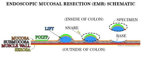 Intro To Endoscopic Mucosal Resection Emr