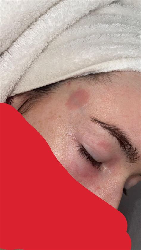 Ringworm Eczema Or Something Else R Dermatologyquestions