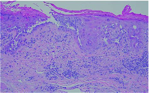 Histopathology Showing Focal Epidermal Suprabasilar Acantholysis And Download Scientific