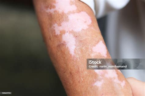 백반증 피부 변색이 있는 노인의 손 클로즈업 계절별 피부 상태를 가진 삶의 방식 피부에 반점을 일으키는 상태인 백반증은 투쟁과
