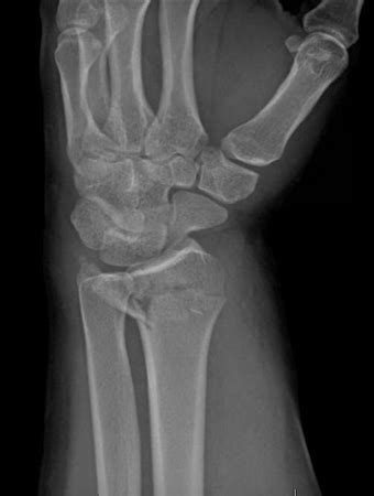 Distal Radius Fractures Trauma Orthobullets