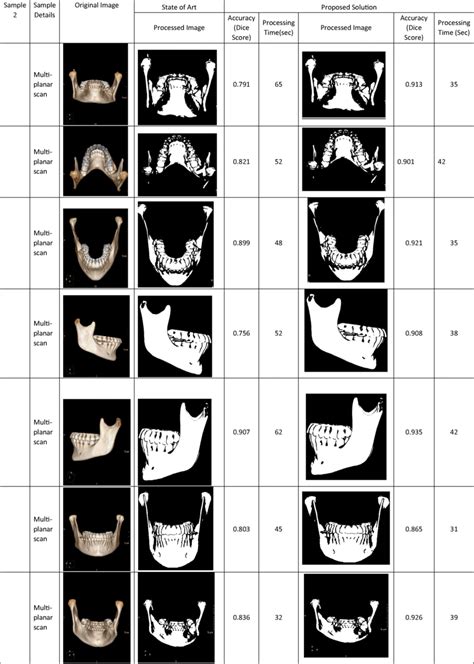 Accuracy And Processing Time For The Segmentation Of Mandible Bones
