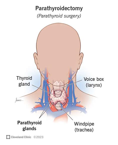 Parathyroidectomy What It Is Side Effects And Recovery