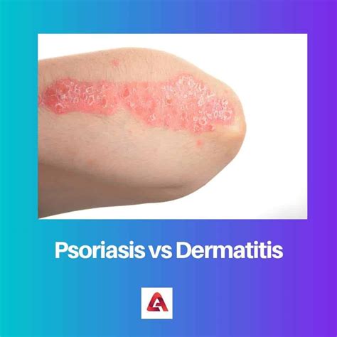 Psoriasis Vs Dermatitis Difference And Comparison