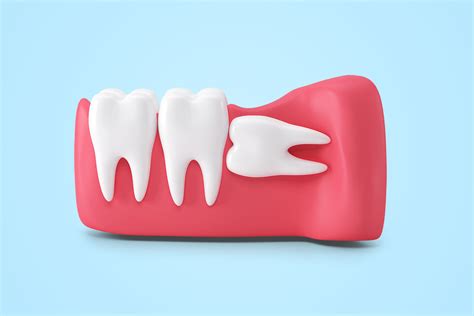 사랑니 발치 후 신경 손상 회복될까 닥터나우